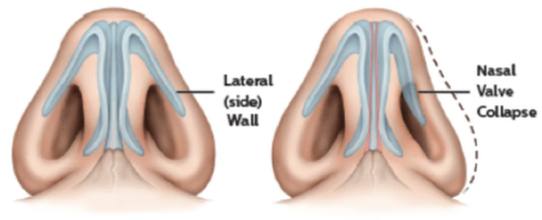 Nasal Valve Collapse Indianapolis | Nasal Obstruction Columbus